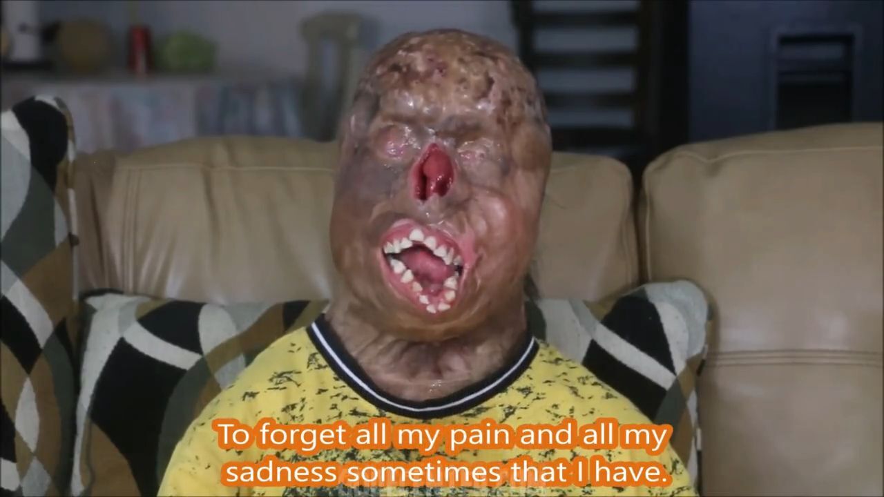 Interview with a survivor of severe burns • GoreCenter